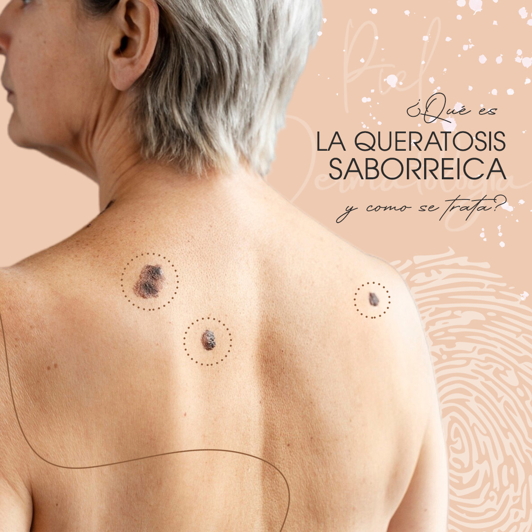 ¿Qué es la queratosis seborreica y cómo se trata? - Piel Dermatología